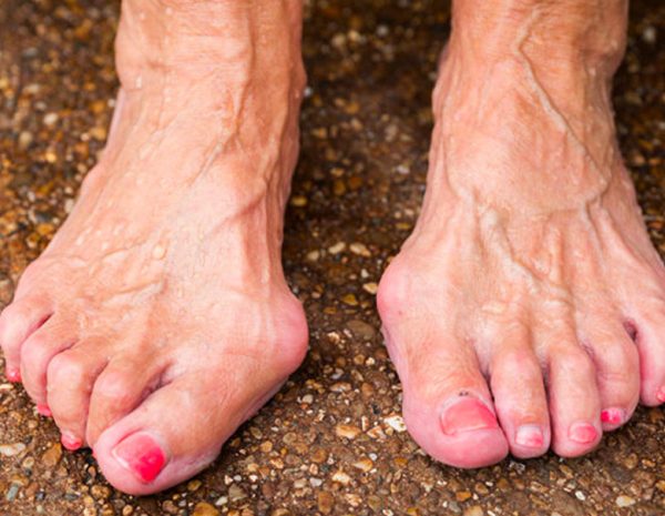 Toe Deformities - Aldershot Foot Clinic
